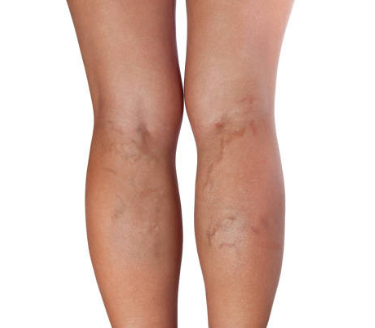 Várices y varículas - SkinCare