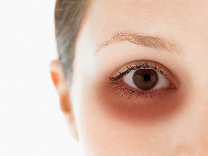 Ojeras moradas | SKINCARE